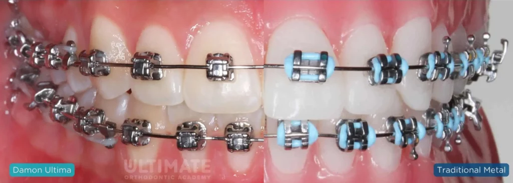 Damon Ultima Brackets vs. Traditional Metal Brackets: Key Differences ...